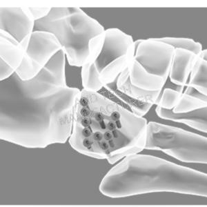 Secure Your Steps With Foot Locking Plate System - Factory Direct Quality